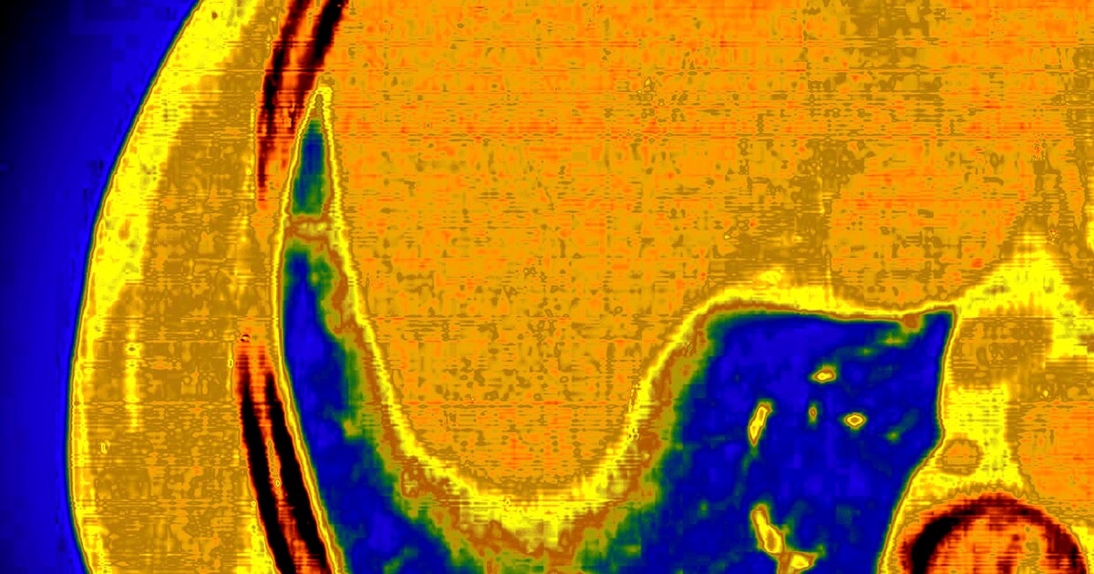 Regelmatig screenen verlaagt longkankersterfte bij (ex)rokers, maar ...