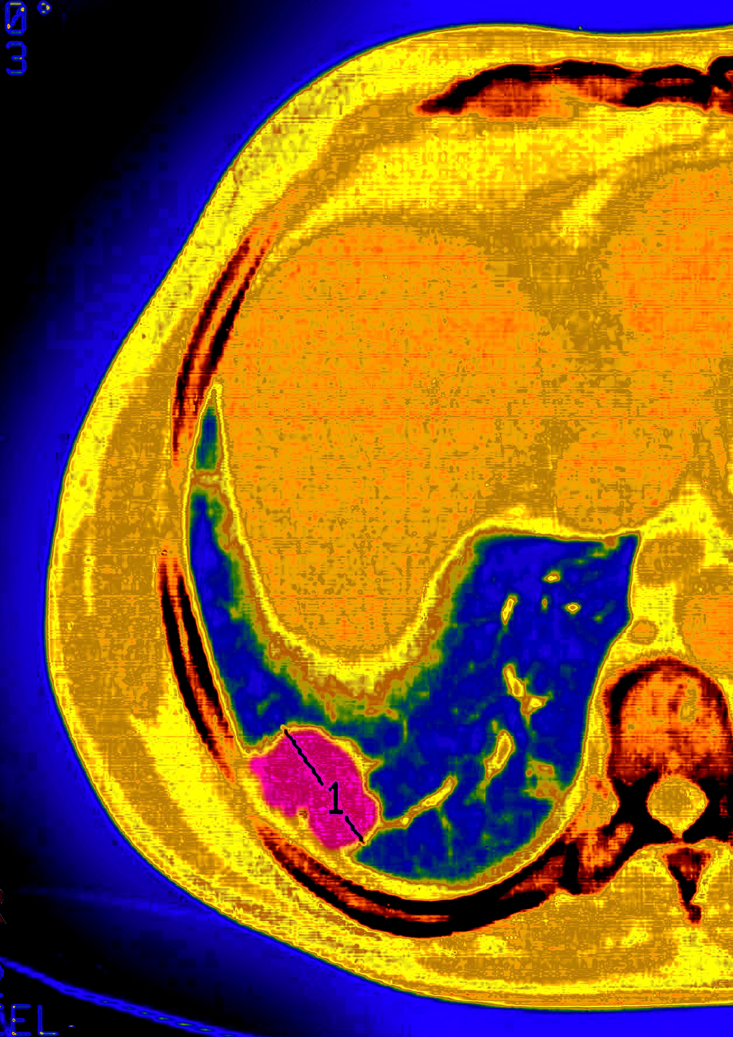 Regelmatig screenen verlaagt longkankersterfte bij (ex)rokers, maar ...