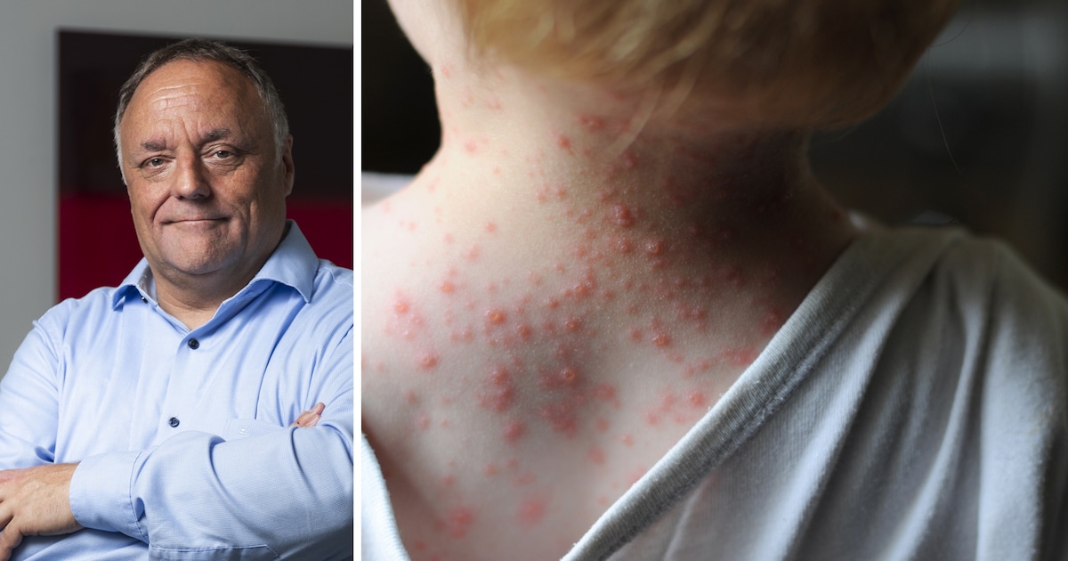 Marc Van Ranst gekant tegen nieuwe regels windpokken: ‘Alsof we niets ...