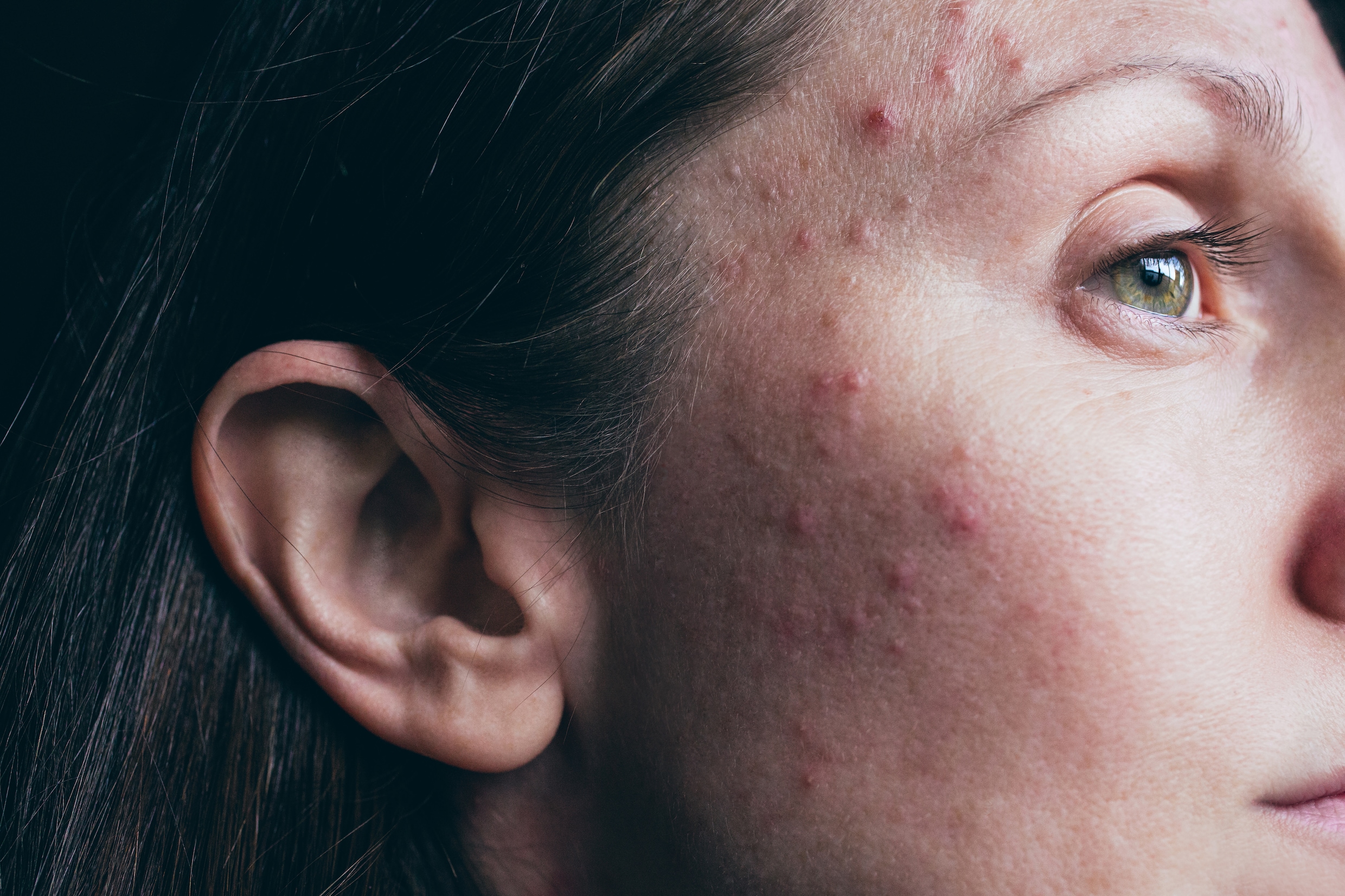 Waarom krijgen ook volwassenen acne? Het is hormonaal | De Morgen