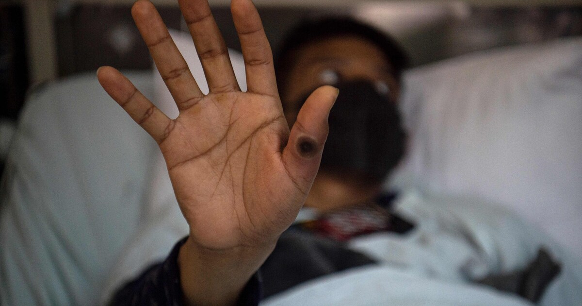 Nieuwe dodelijkere variant van apenpokken vastgesteld in Zweden | De Morgen