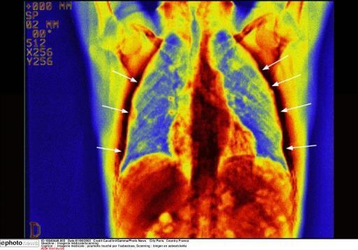 Brit sterft aan kanker in getransplanteerde rokerslongen | De Morgen