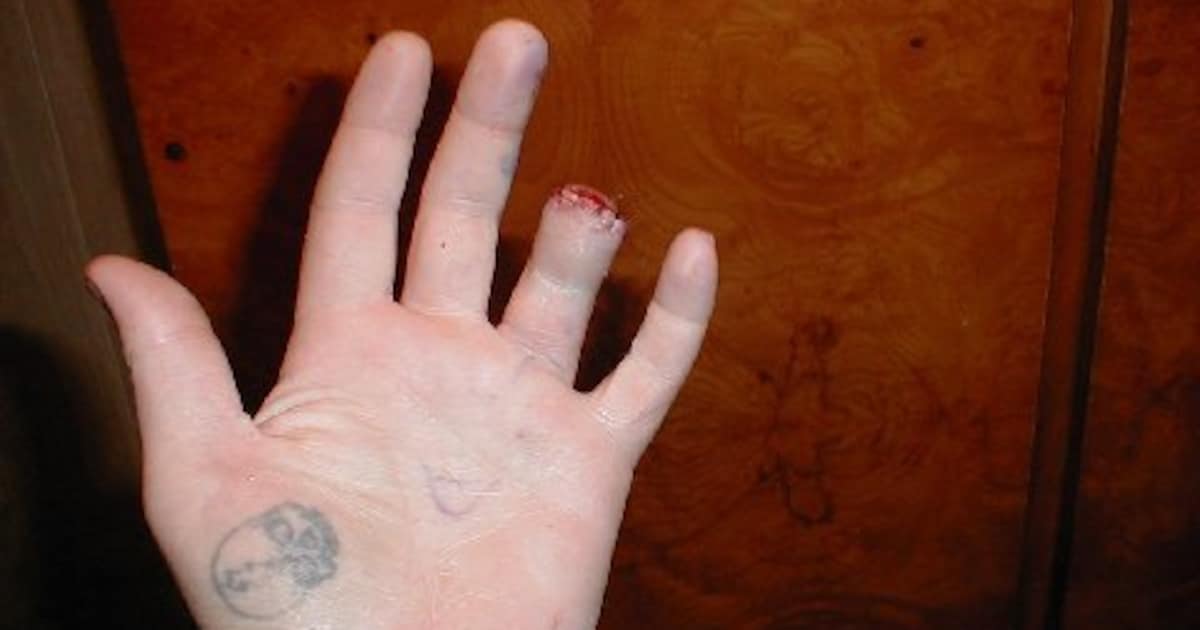 Nederlander bijt vinger af tijdens ruzie | De Morgen