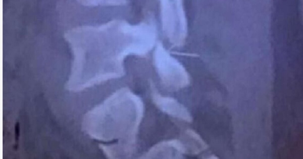 Röntgenfoto gebroken ruggenwervel Neymar gaat de wereld rond | De Morgen